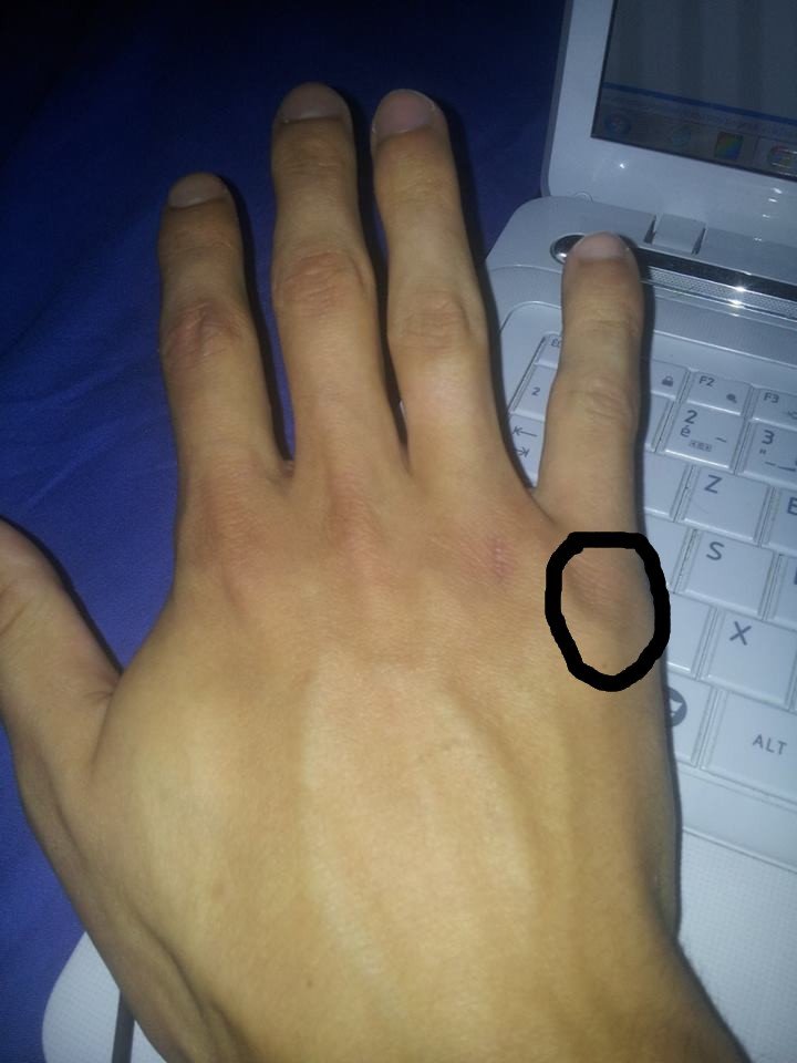 Douleurs phalange coup de poing avis sur le forum Blabla 18-25 ans - 19 ...