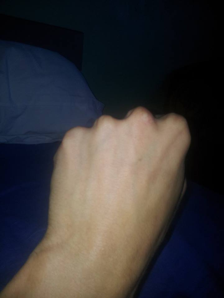 Douleurs phalange coup de poing avis sur le forum Blabla 18-25 ans - 19 ...