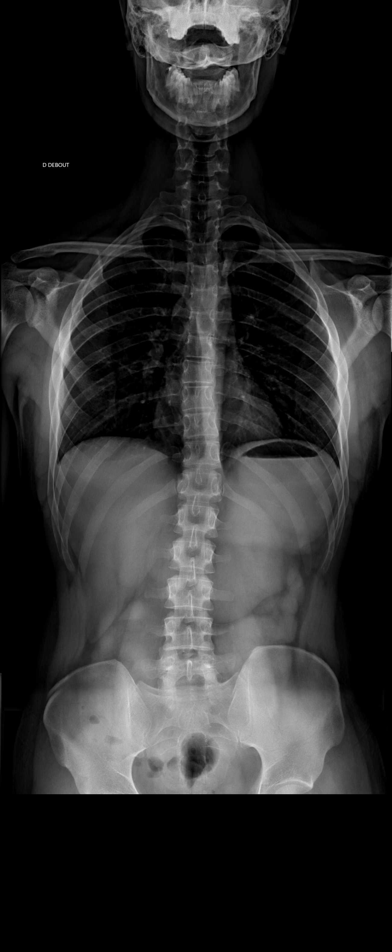 I have a mild Levoscoliosis with pain. Can you tell me my curve degree ...