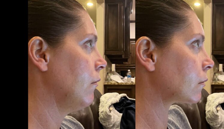 Orthognathic Surgery done - Still Need Genio? : r/jawsurgery